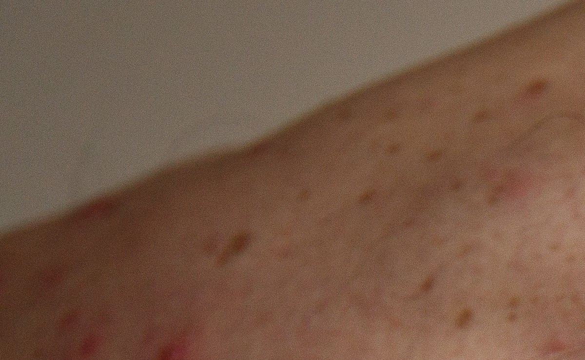 Cómo combatir el acné corporal, según dermatólogos - Estar Mejor